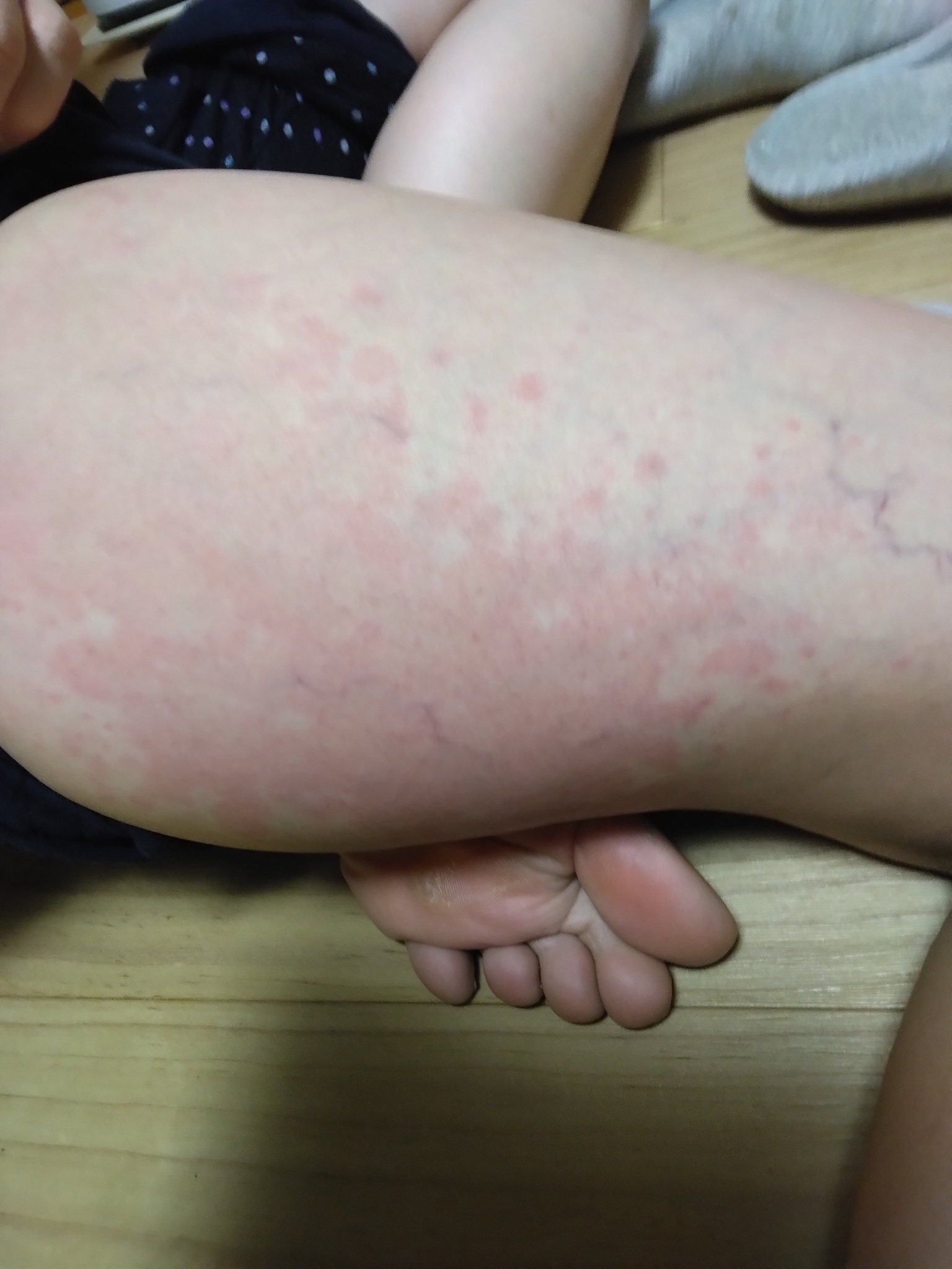 おはなさんのダイアリー：TC療法 タモキシフェンとリュープリン | Peer Ring - なかまと話そう！女性特有のがん