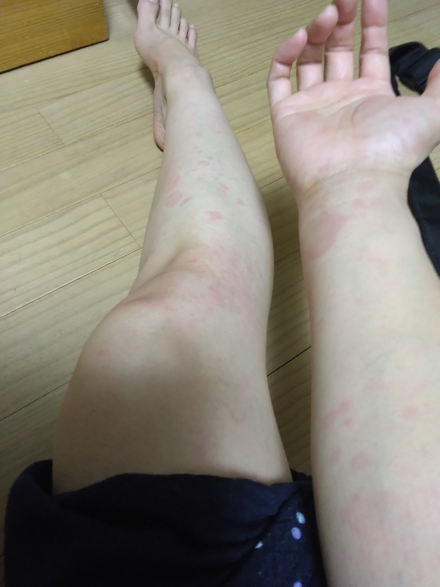 おはなさんのダイアリー：TC療法 タモキシフェンとリュープリン | Peer Ring - なかまと話そう！女性特有のがん